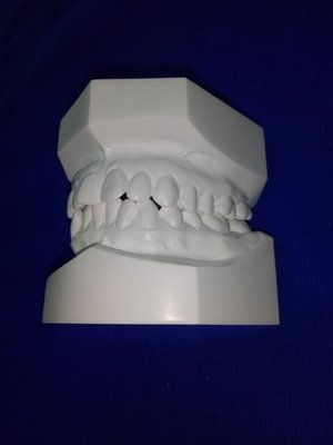 Smooth Surface Orthodontic Appliances 3D Printing Models For Dental Laboratory