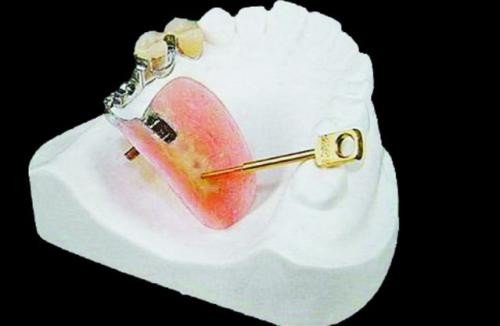 Dental Precision Attachment Partial Denture For Teeth Good Biocompatibility