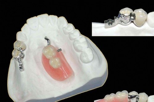 Dental Precision Attachment Partial Denture For Teeth Good Biocompatibility