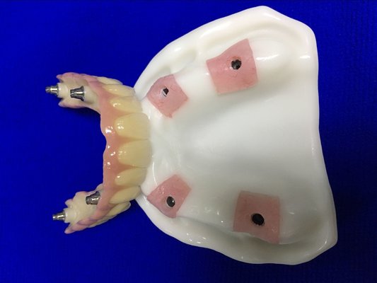 Dental Lab Titanium Hader Bar Attachments For Comestic Defects Implants