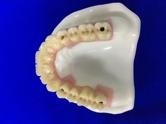 Dental Lab Titanium Hader Bar Attachments For Comestic Defects Implants