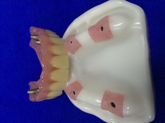 Hybrid Bar Attachment Metal Based Dentures For Screwed Retained Defects Implants