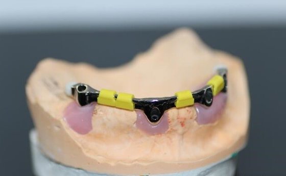 Titanium Dental Implant Hader Bar Attachments Locked On Full Dentures