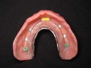 Titanium Dental Implant Hader Bar Attachments Locked On Full Dentures