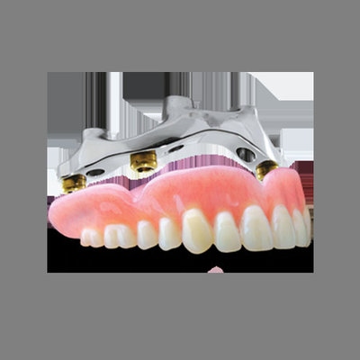Dental Fixed Hybrid Denture Overbar Implant Attachment Corrosion Resistance