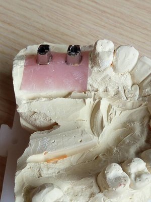 Dental Laboratory Titanium Custom Fabricated Abutment For Tooth Treatment
