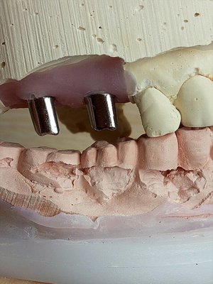 Dental Laboratory Titanium Custom Fabricated Abutment For Tooth Treatment