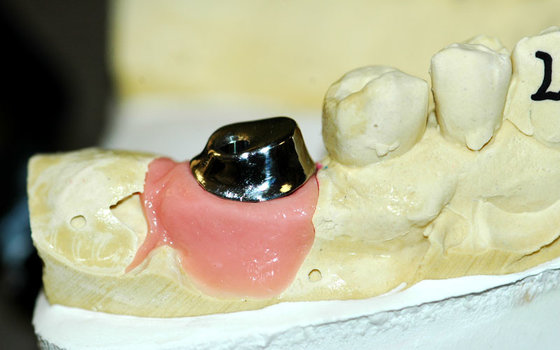 Dental Laboratory Custom Implant Abutment Titanium Abutment Durable Comfortable