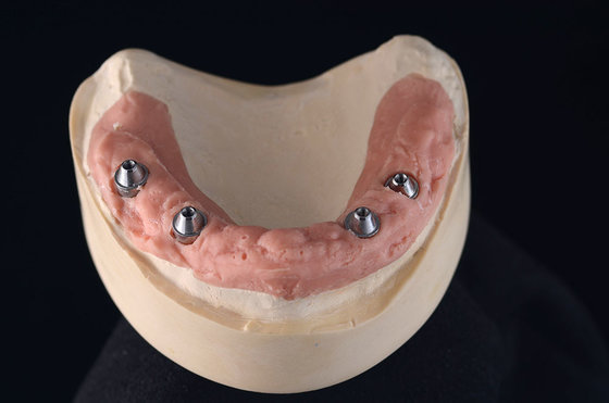 Dental Lab Implant Bar Attachment Tooth Retained Overdenture With Titanium Material