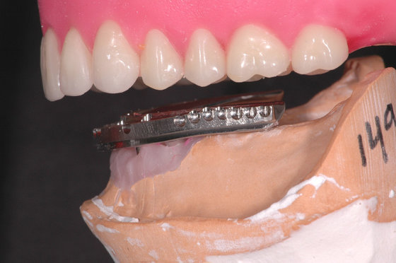 Professional Dental Implant Attachments , Implant Overdenture Attachments