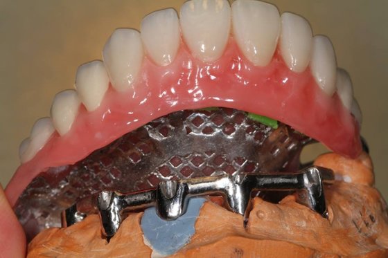Removable Implant Bar Attachment Hader Bar Overdenture For Denture Supporting