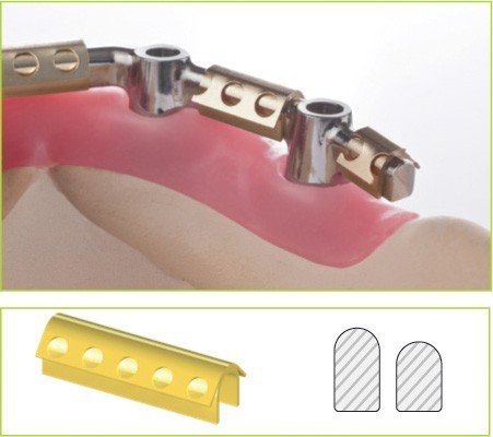 Dental Implant Locator Attachment O Ring Studs , Full Denture Hader Bar Attachment
