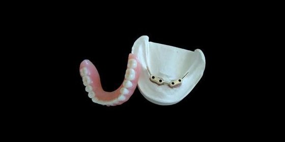 Hybrid Implant Supported Dentures / Tooth Supported Overdenture Attachments