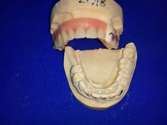 Acrylic Partial Denture / Dental Acrylic Teeth In Dentistry Quick And Easy To Make