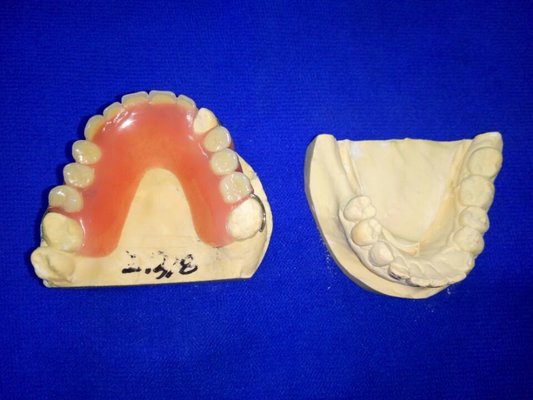 Acrylic Partial Denture / Dental Acrylic Teeth In Dentistry Quick And Easy To Make