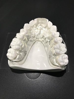 Traditional Lingual Arch Orthodontic Dental Retainer Removable To Straighten Teeth