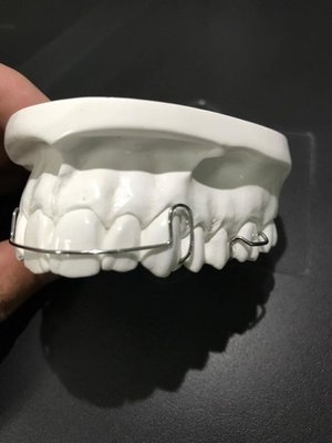 Straightening Teeth Functional Orthodontic Appliances Geheel Open Activator FDA Approved