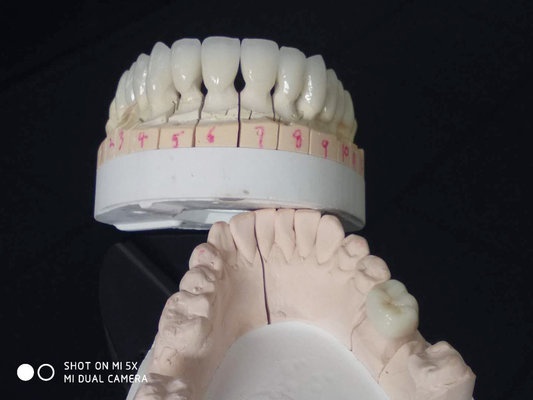 1M1 Shade Full Contoured Zirconia Crown & Bridge With FDA ISO Certificate