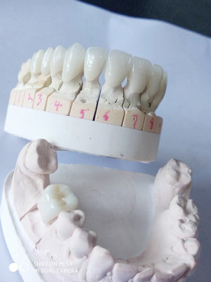 1M1 Shade Full Contoured Zirconia Crown & Bridge With FDA ISO Certificate