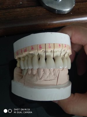 1M1 Vita Shade Full Zirconia Dental Crown Lab Fabricating Dentures To Worldwide Clinics