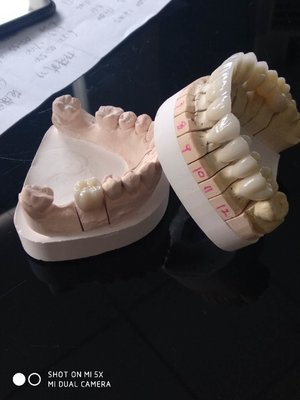 1M1 Vita Shade Full Zirconia Dental Crown Lab Fabricating Dentures To Worldwide Clinics
