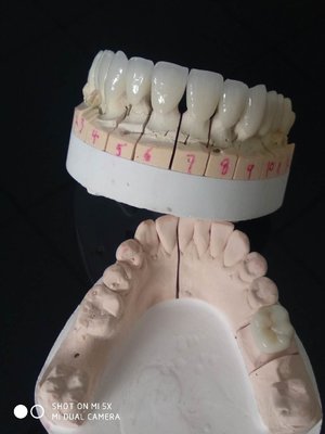 1M1 Vita Shade Full Zirconia Dental Crown Lab Fabricating Dentures To Worldwide Clinics