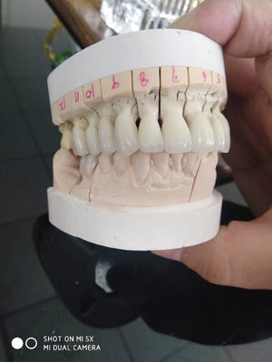 Crown & Bridge Fabricating Dentures With PFZ Technique Offfering Full English Service