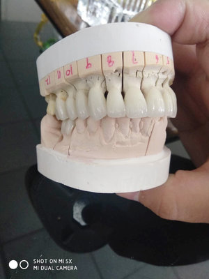 Crown & Bridge Fabricating Dentures With PFZ Technique Offfering Full English Service
