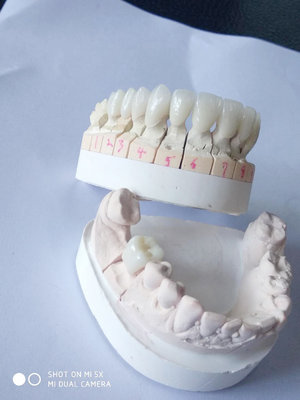 Hospital , Clinic Dental Crown Lab Doing Cases With 3D Digital Work