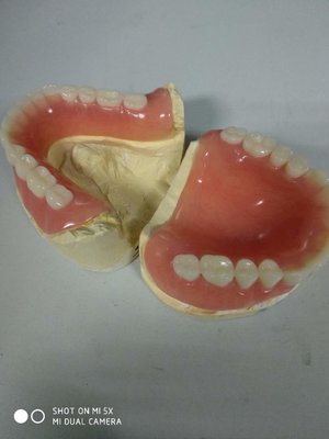Dental Restoraton Acrylic Removable Partial Denture With Composite Teeth , Easy To Clean