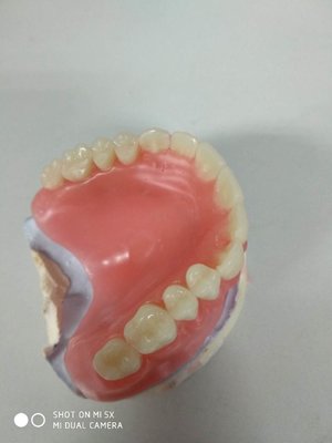 Diagnostic Dental Crown Lab , Accurate Diagnostic Wax Up Model To Produce Precise Fitting Dental Restoration