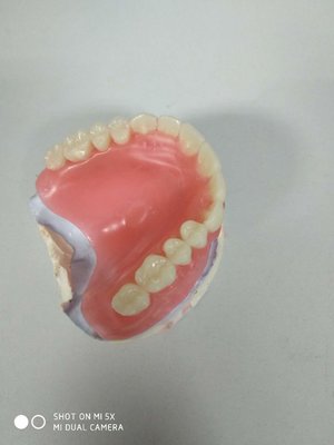 Diagnostic Dental Crown Lab , Accurate Diagnostic Wax Up Model To Produce Precise Fitting Dental Restoration