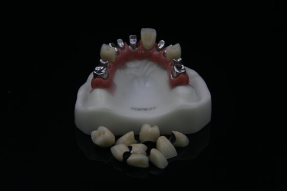 Strong and Biocompatible Dental Implant Crown With Zirconia Denture