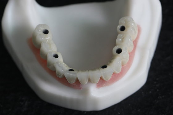Strong and Biocompatible Dental Implant Crown With Zirconia Denture