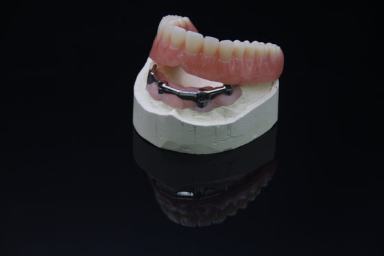 Removable Dental Implant Supported Dentures As Overdenture Attachments