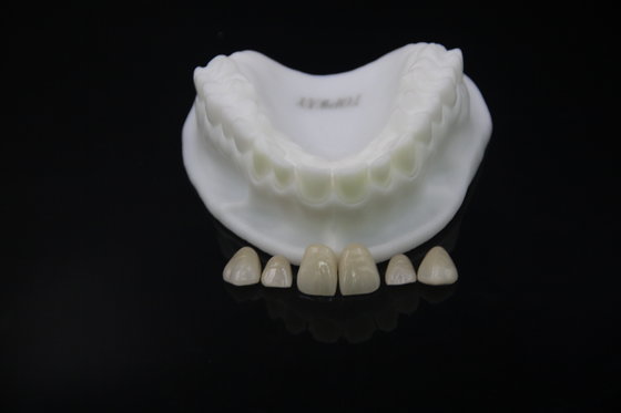Full Ceramics Porcelain Dental Veneers Metal Free Long Lasting In Cosmetic Dentistry