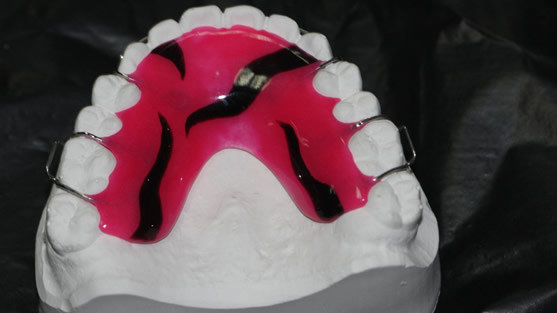 Functional Appliances In Orthodontics , Anti - Snoring Device Mouth Guard