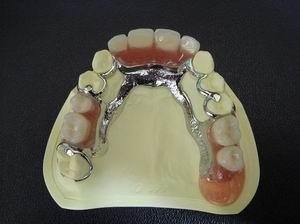 False Teeth Dentures Cast Partial Framework High Antibiosis Excellent Fracture Resistance