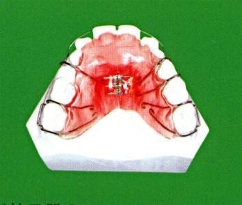Dental Expansion Appliances Orthodontics One Dimensional Labial Plastic Tray Material