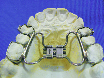 Band Rapid Arch Expansion Dental Appliances Retainer To Straighten Bottom Teeth