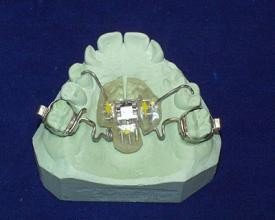 Pendulum Spring Types Orthodontic Appliances Invisible Braces For Dental Clinic