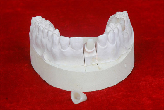 Classic and Competitive PFM Dental Crown Porcelain Dental Post and Core