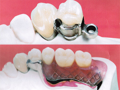 No Allergy Teeth Dental Precision Attachments High Retention FDA ISO9001 Certification