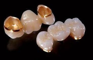 Gold composite Captek Nanogold crowns restoration better gingival health