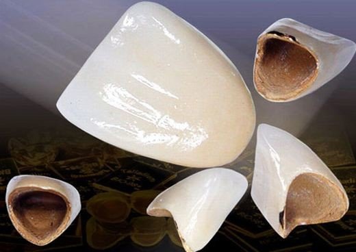 Gold composite Captek Naogold crowns restoration better gingival health
