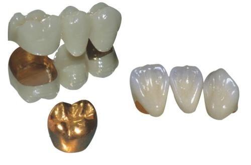 Honorable Gold composite Captek Naogold Crowns Restoration Porcelain bonder