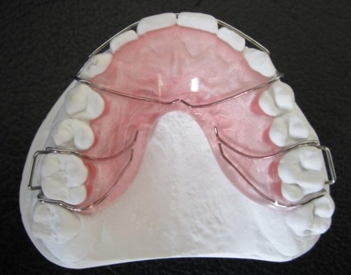 Z Spring Orthodontic Dental Device Orthodontic Treatment For Overbite