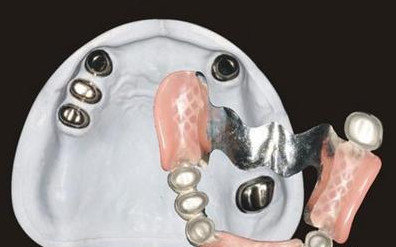 White Gold Precision Partial Denture Attachments  , Telescopic Dentures And Bridges