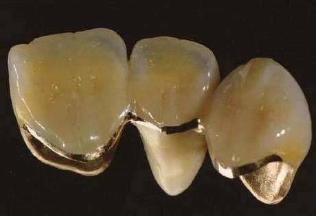 High Noble White Gold PFM Dental Crown , Porcelain Fused To Metal Bridge In Dentistry