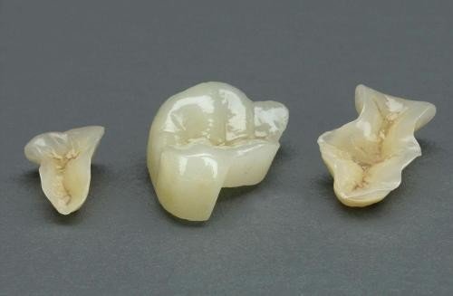 Dental Porcelain Inlays And Onlays Distinguished And Honorable No Any Allergy Glass